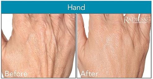 Radiesse Filler for Hands, Our Anti Aging Hand Treatment Replaces ...